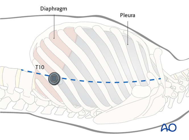 Anterior thoracoscopic approach