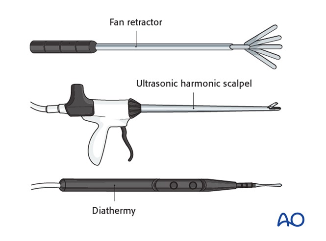 Anterior thoracoscopic approach