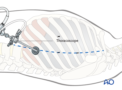 Anterior thoracoscopic approach