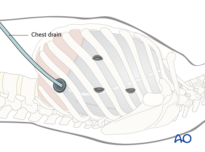 Anterior thoracoscopic approach