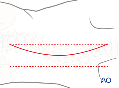 Posterior approach