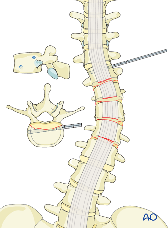 Anterior open for Lenke 5