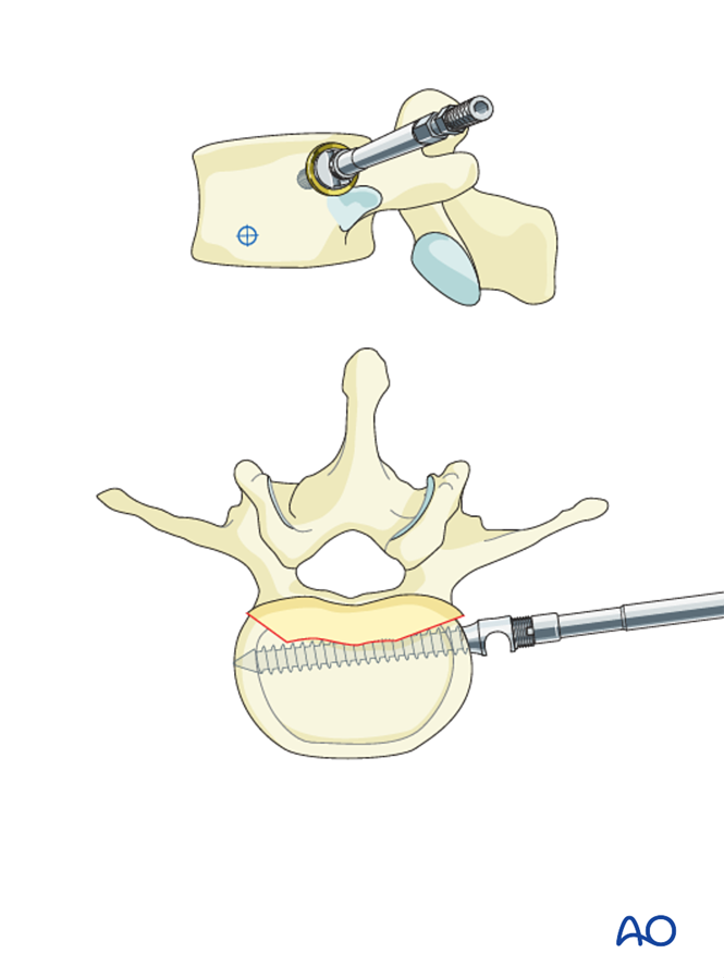Anterior open for Lenke 5