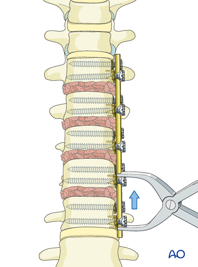 Anterior open for Lenke 5