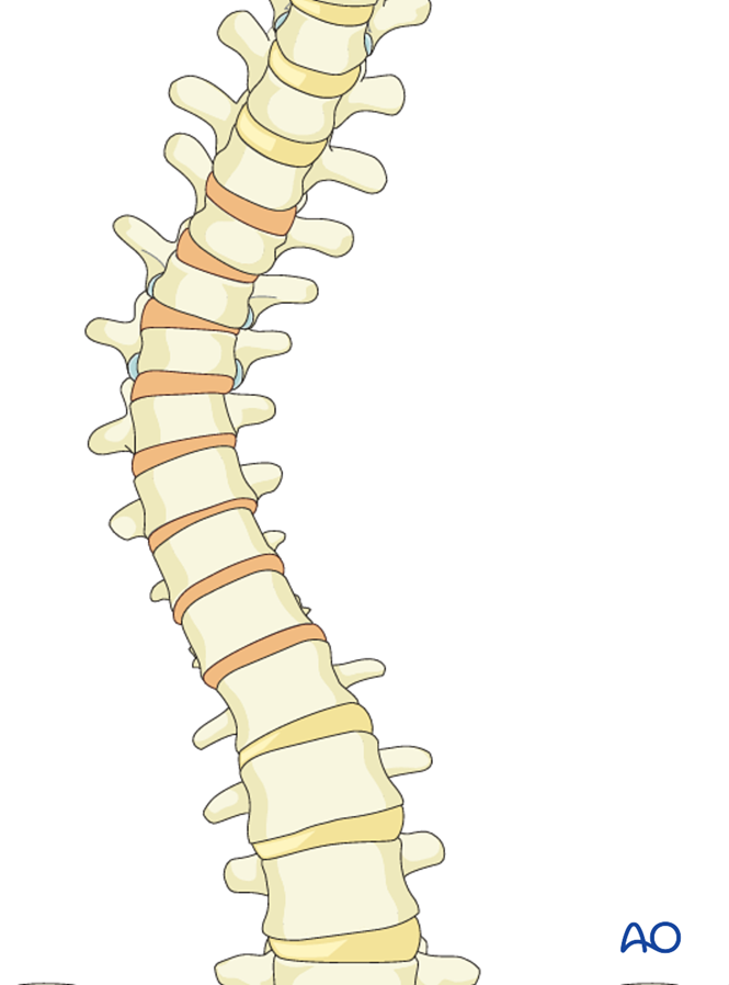 Anterior open for Lenke 1