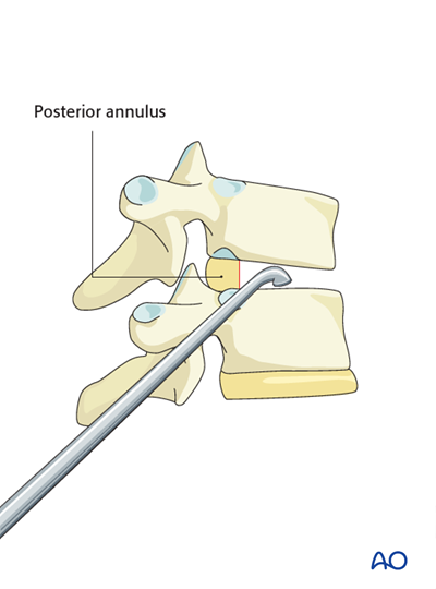 Anterior open for Lenke 1