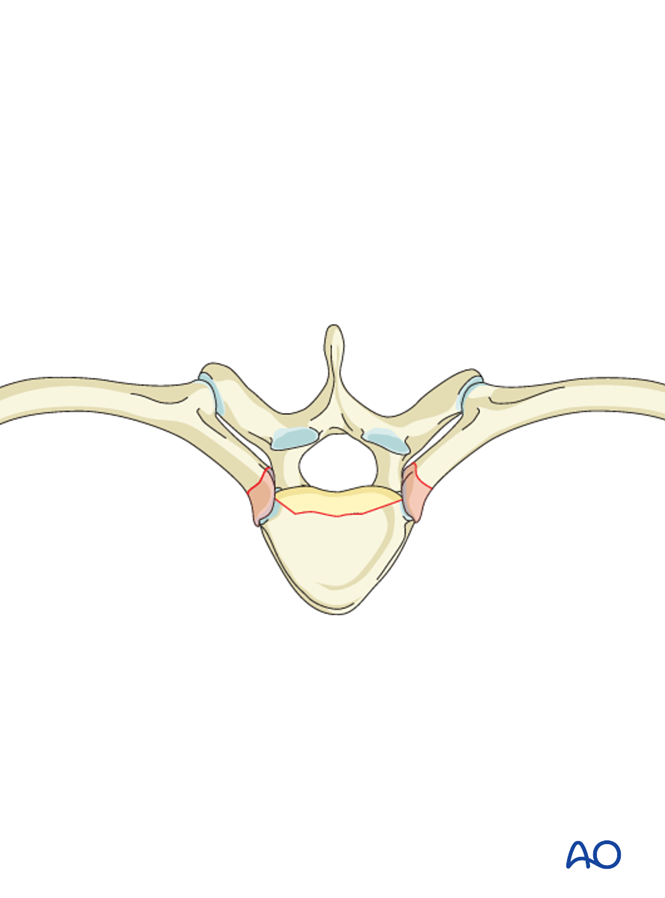 Anterior open for Lenke 1