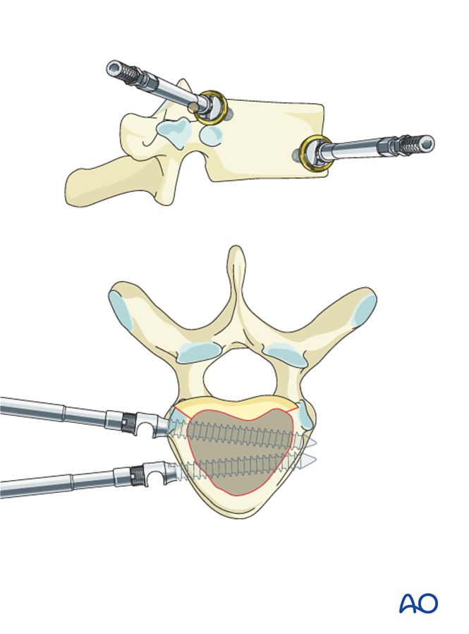 Anterior open for Lenke 1