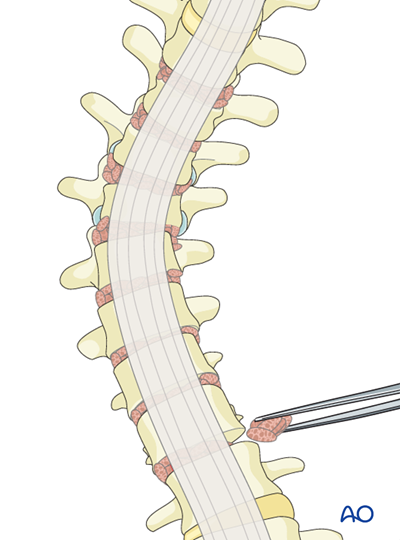 Anterior open for Lenke 1