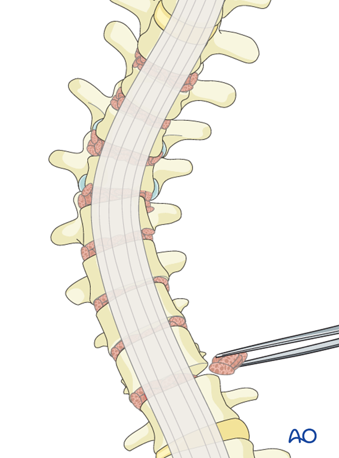 Anterior open for Lenke 1