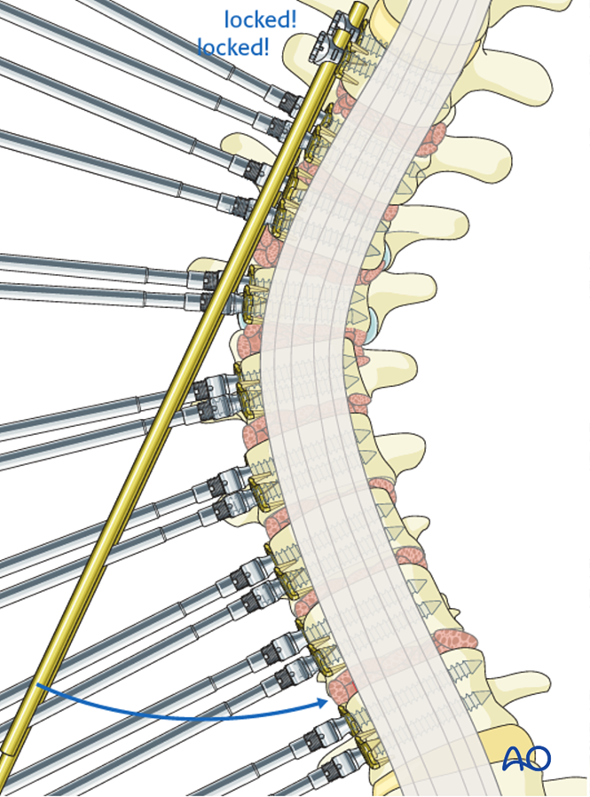Anterior open for Lenke 1