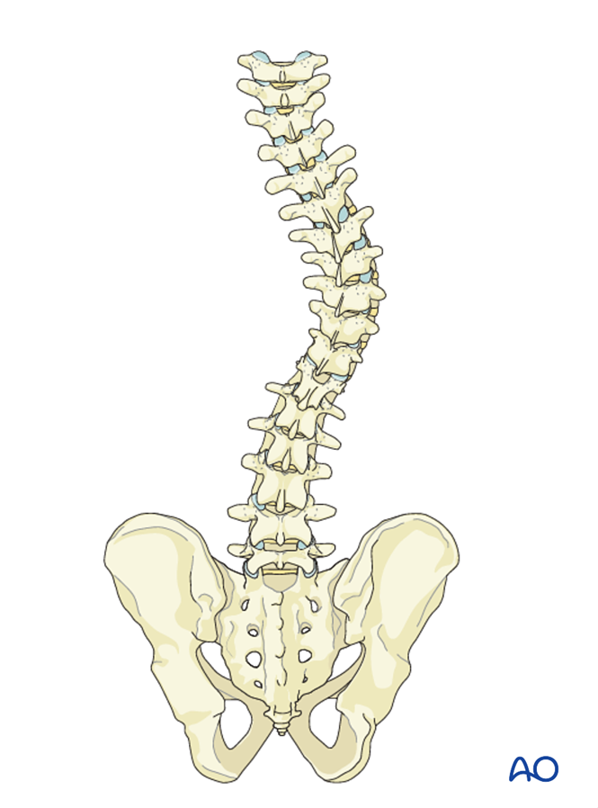 Posterior Screws - With direct vertebral body derotation for Lenke 1