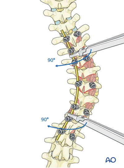 Posterior Screws - No direct vertebral body derotation for Lenke 1