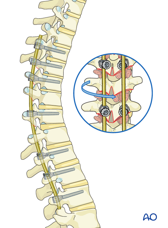 Posterior Screws - No direct vertebral body derotation for Lenke 1