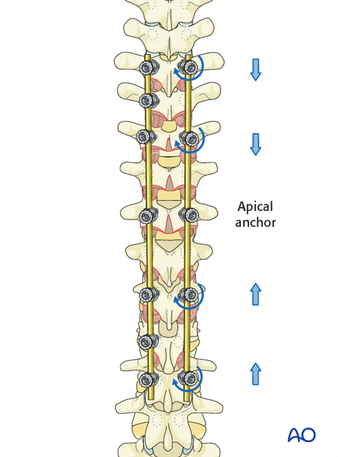 Posterior Screws - No direct vertebral body derotation for Lenke 1