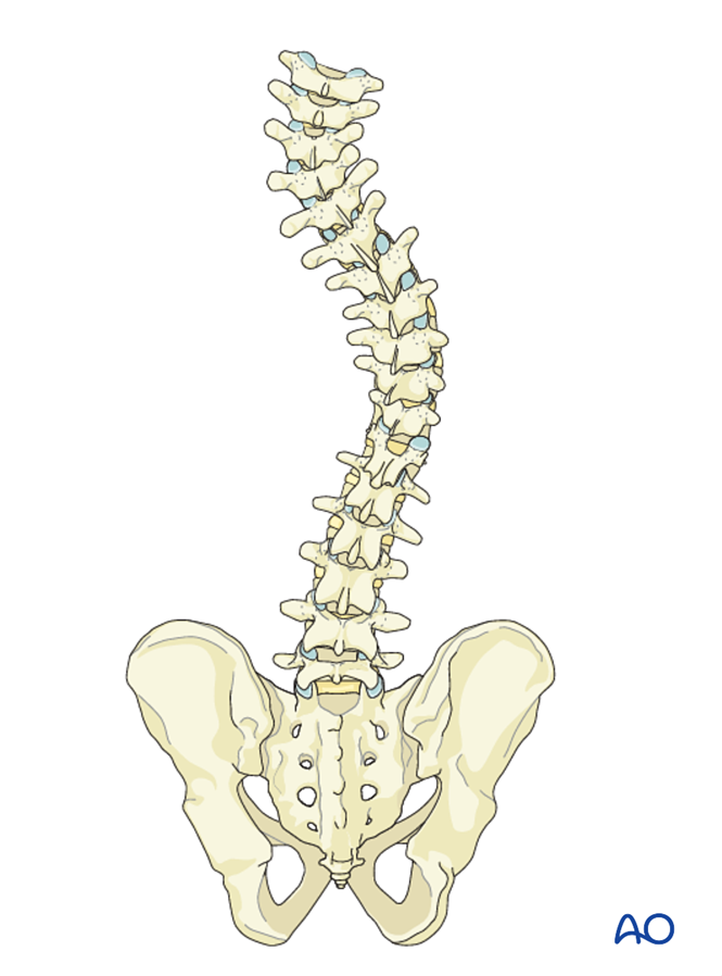 Posterior Screws - With direct vertebral body derotation for Lenke 2