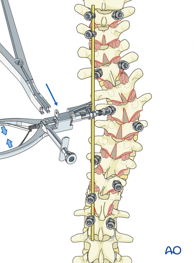 Posterior Screws - No direct vertebral body derotation for Lenke 2