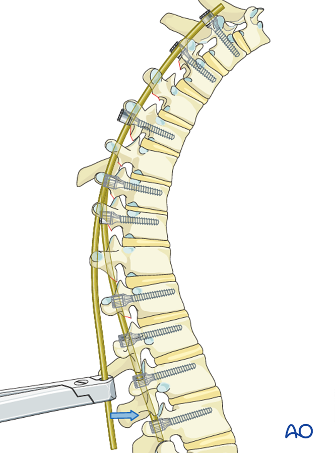 Posterior Screws - No direct vertebral body derotation for Lenke 2