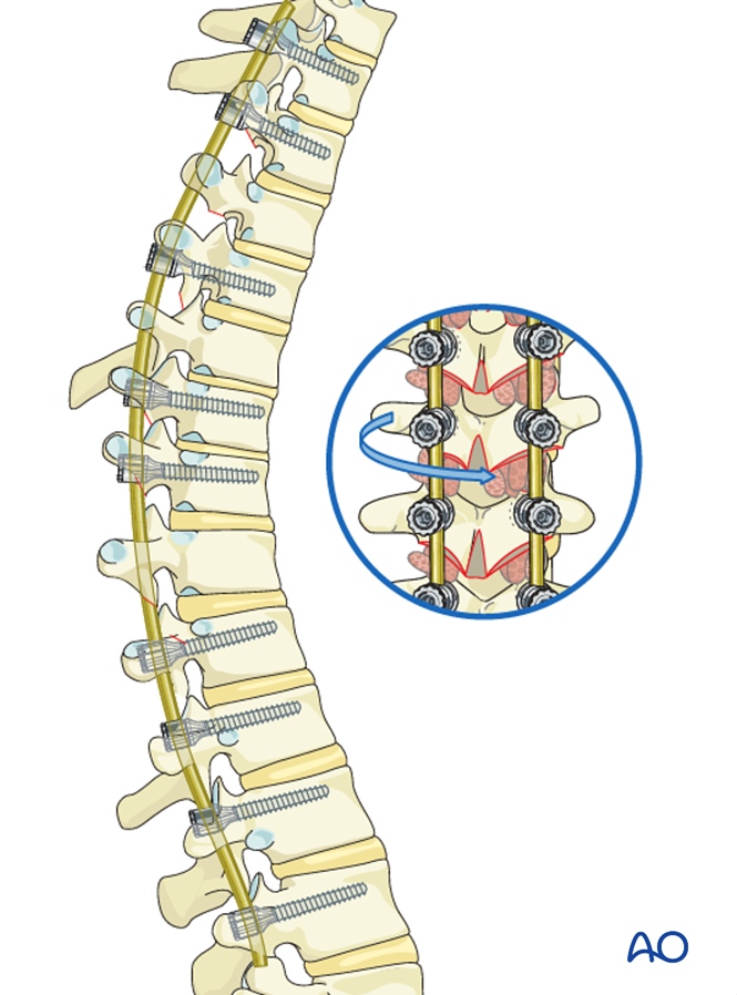 Posterior Screws - No direct vertebral body derotation for Lenke 2