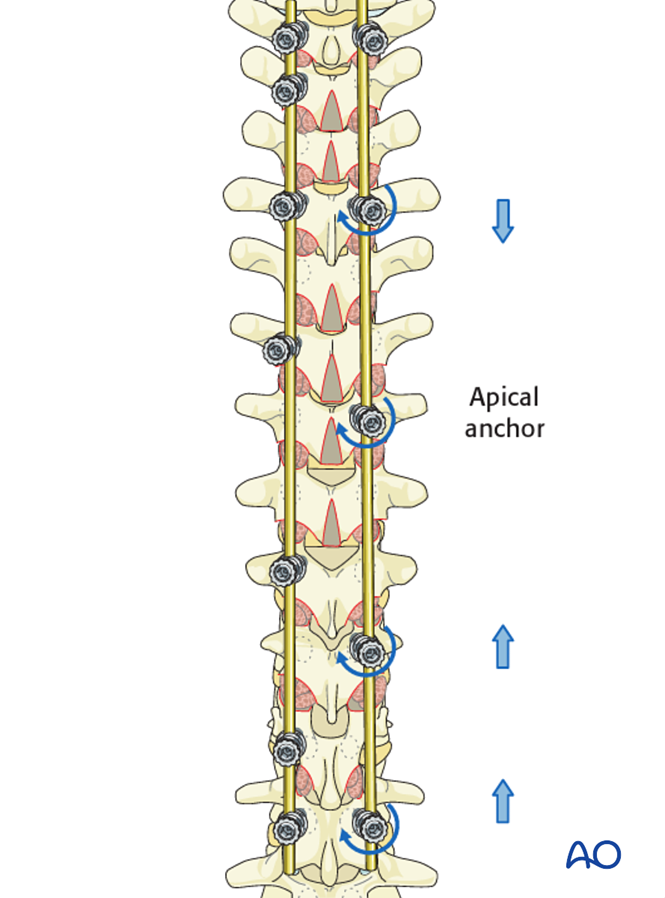 Posterior Screws - No direct vertebral body derotation for Lenke 2