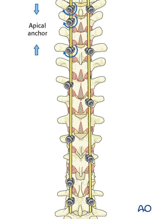 Posterior Screws - No direct vertebral body derotation for Lenke 2