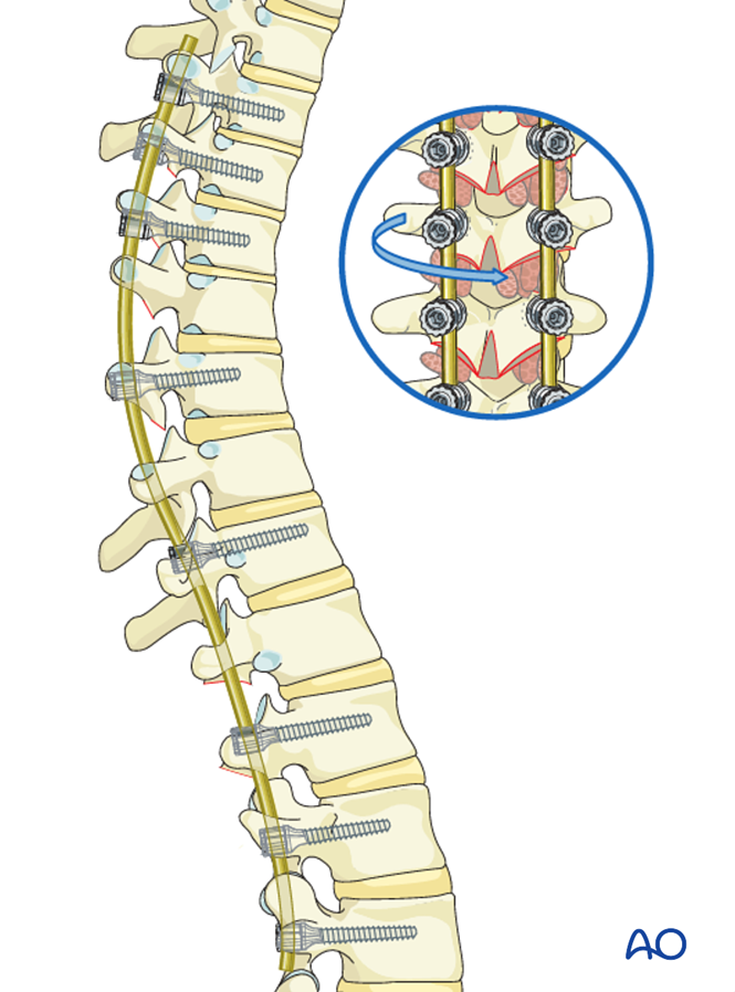 Posterior Screws - No direct vertebral body derotation for Lenke 3
