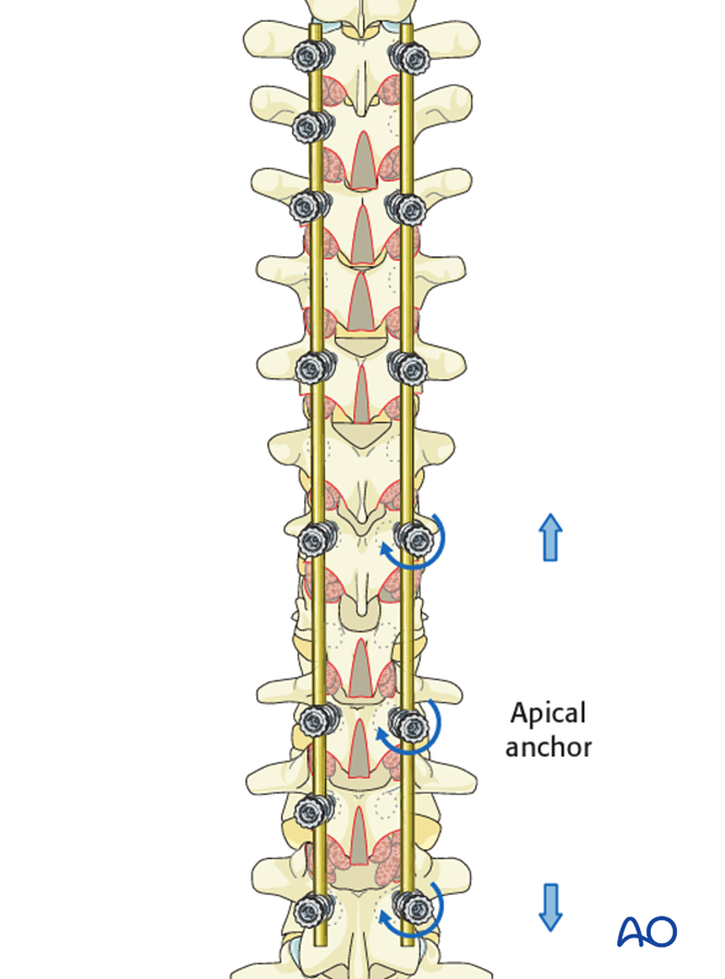 Posterior Screws - No direct vertebral body derotation for Lenke 3