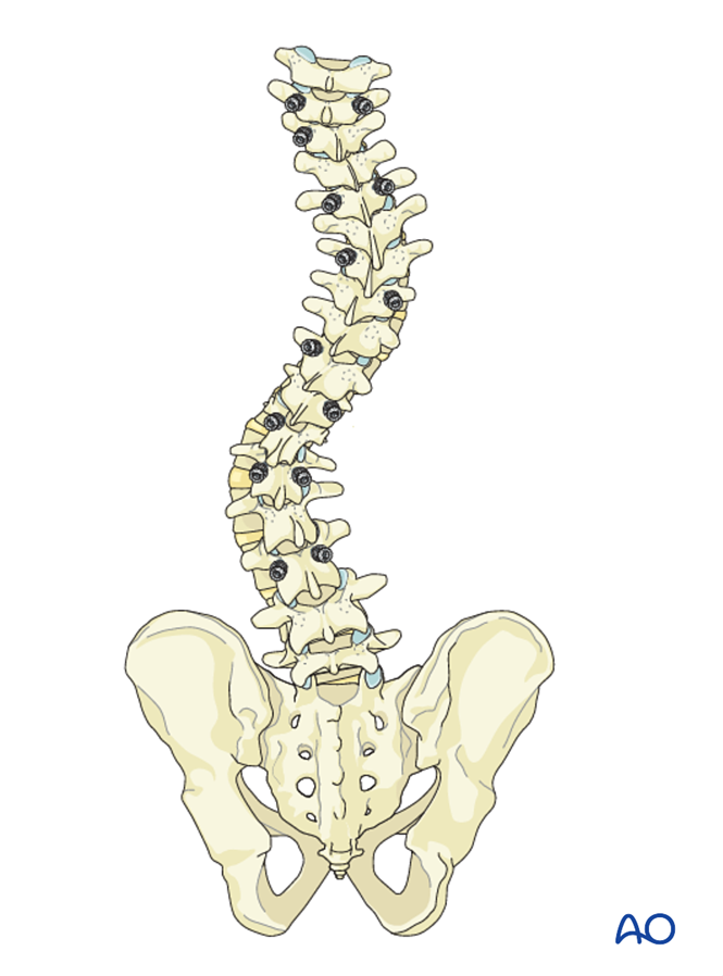 Posterior Screws - With direct vertebral body derotation for Lenke 4
