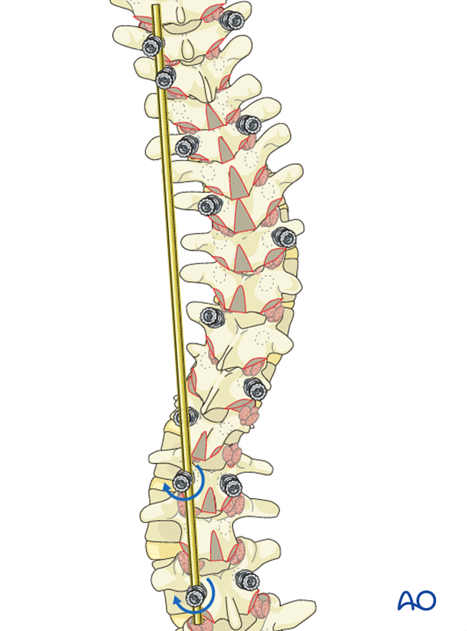 Posterior Screws - No direct vertebral body derotation for Lenke 4
