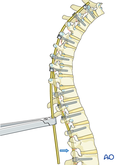 Posterior Screws - With direct vertebral body derotation for Lenke 4