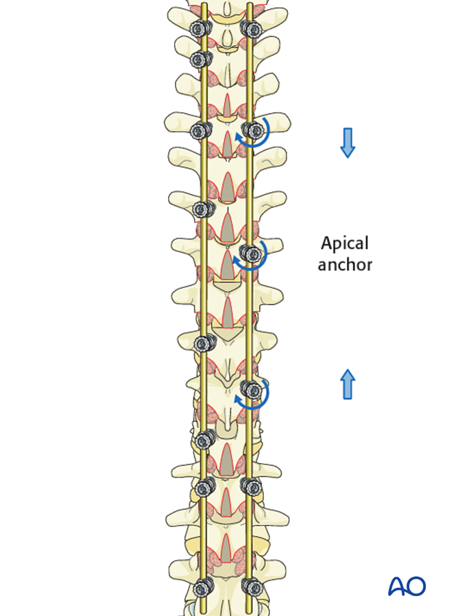 Posterior Screws - No direct vertebral body derotation for Lenke 4