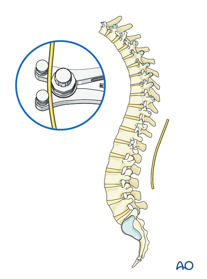 Posterior Screws - With direct vertebral body derotation for Lenke 5