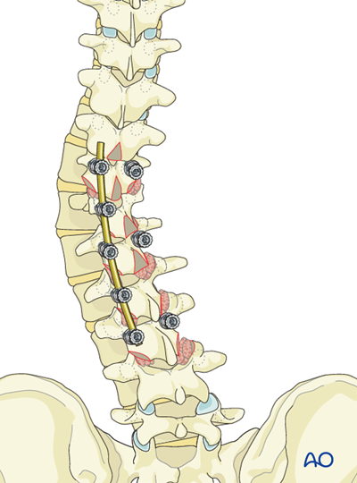Posterior Screws - No direct vertebral body derotation for Lenke 5