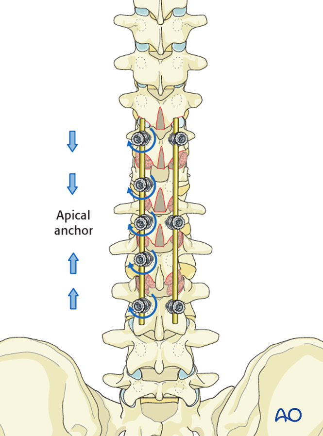 Posterior Screws - No direct vertebral body derotation for Lenke 5