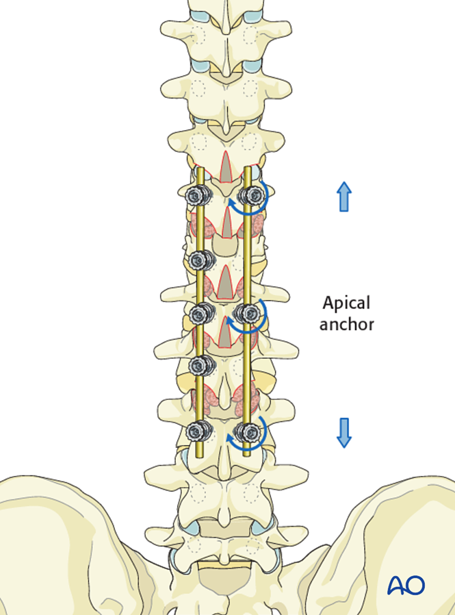 Posterior Screws - No direct vertebral body derotation for Lenke 5