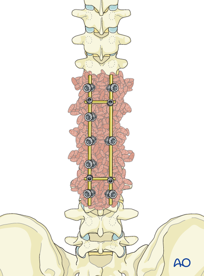 Posterior Screws - No direct vertebral body derotation for Lenke 5