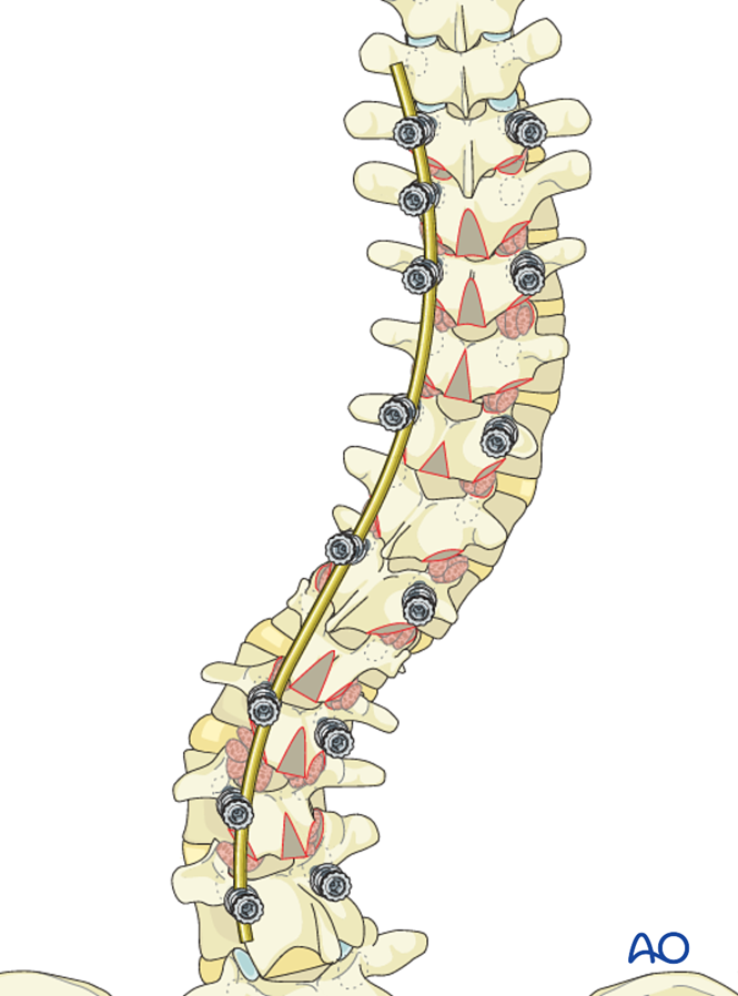 Posterior Screws - With direct vertebral body derotation for Lenke 6