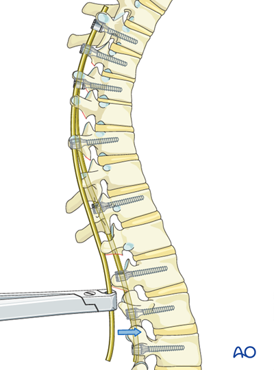 Posterior Screws - With direct vertebral body derotation for Lenke 6