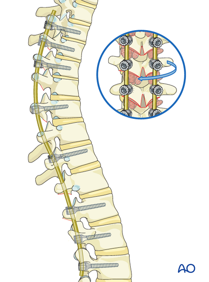Posterior Screws - With direct vertebral body derotation for Lenke 6