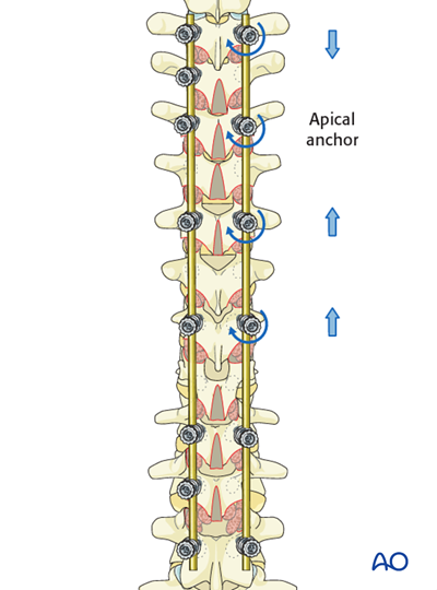 Posterior Screws - No direct vertebral body derotation for Lenke 6
