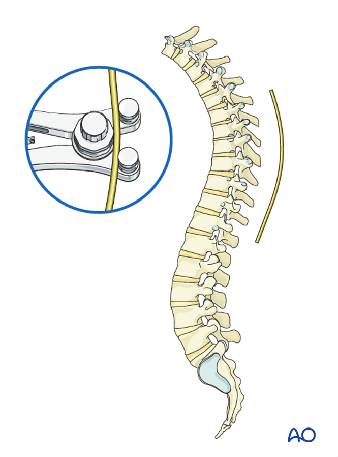 Posterior Screws - With direct vertebral body derotation for Lenke 1