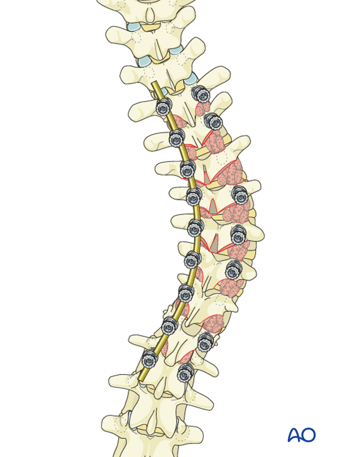 Posterior Screws - With direct vertebral body derotation for Lenke 1