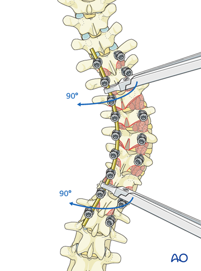 Posterior Screws - With direct vertebral body derotation for Lenke 1