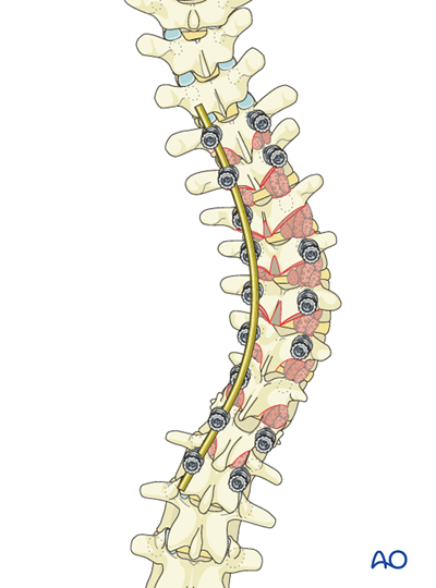Posterior Screws - With direct vertebral body derotation for Lenke 1