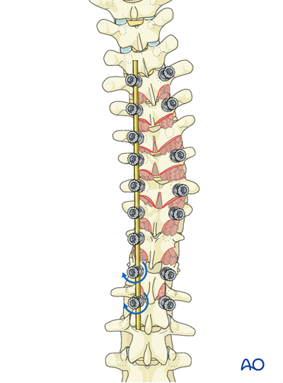 Posterior Screws - With direct vertebral body derotation for Lenke 1