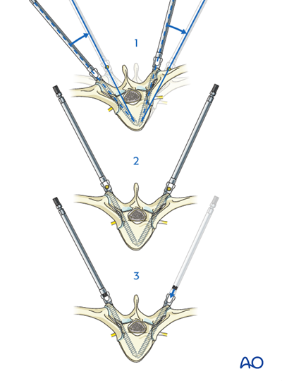 Posterior Screws - With direct vertebral body derotation for Lenke 6