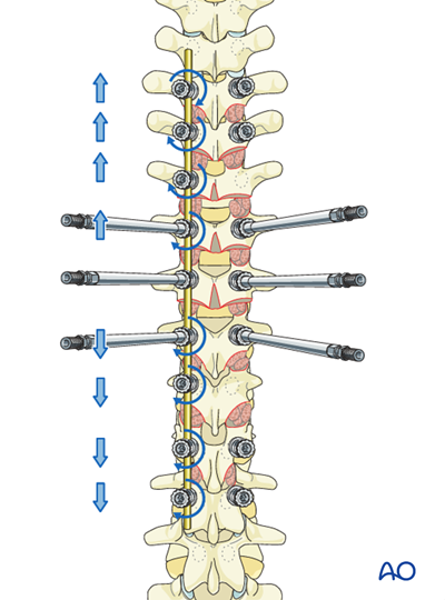 Posterior Screws - With direct vertebral body derotation for Lenke 1