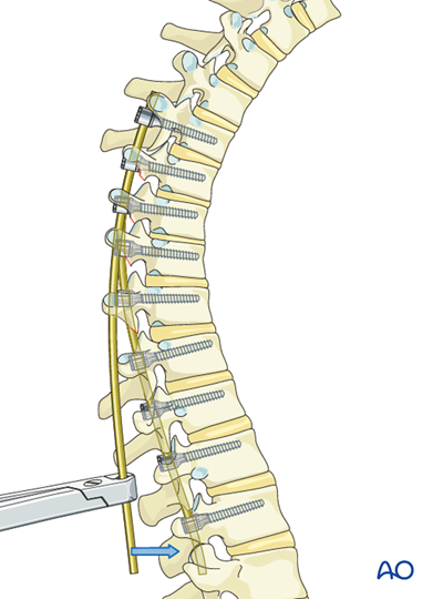 Posterior Screws - With direct vertebral body derotation for Lenke 1