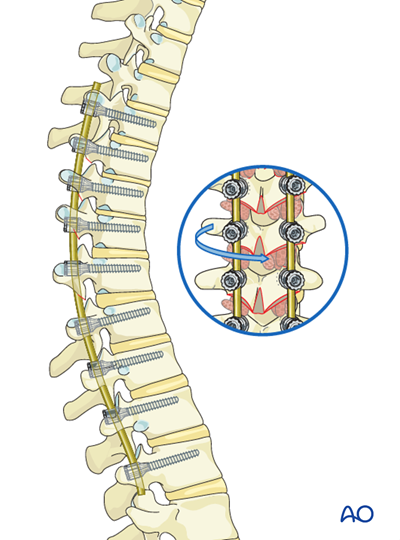 Posterior Screws - With direct vertebral body derotation for Lenke 1