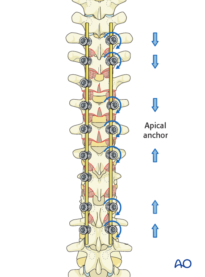 Posterior Screws - With direct vertebral body derotation for Lenke 1